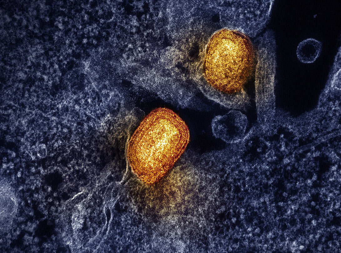 Sweden confirms first case of Mpox Clade I outside Africa amid Global ...